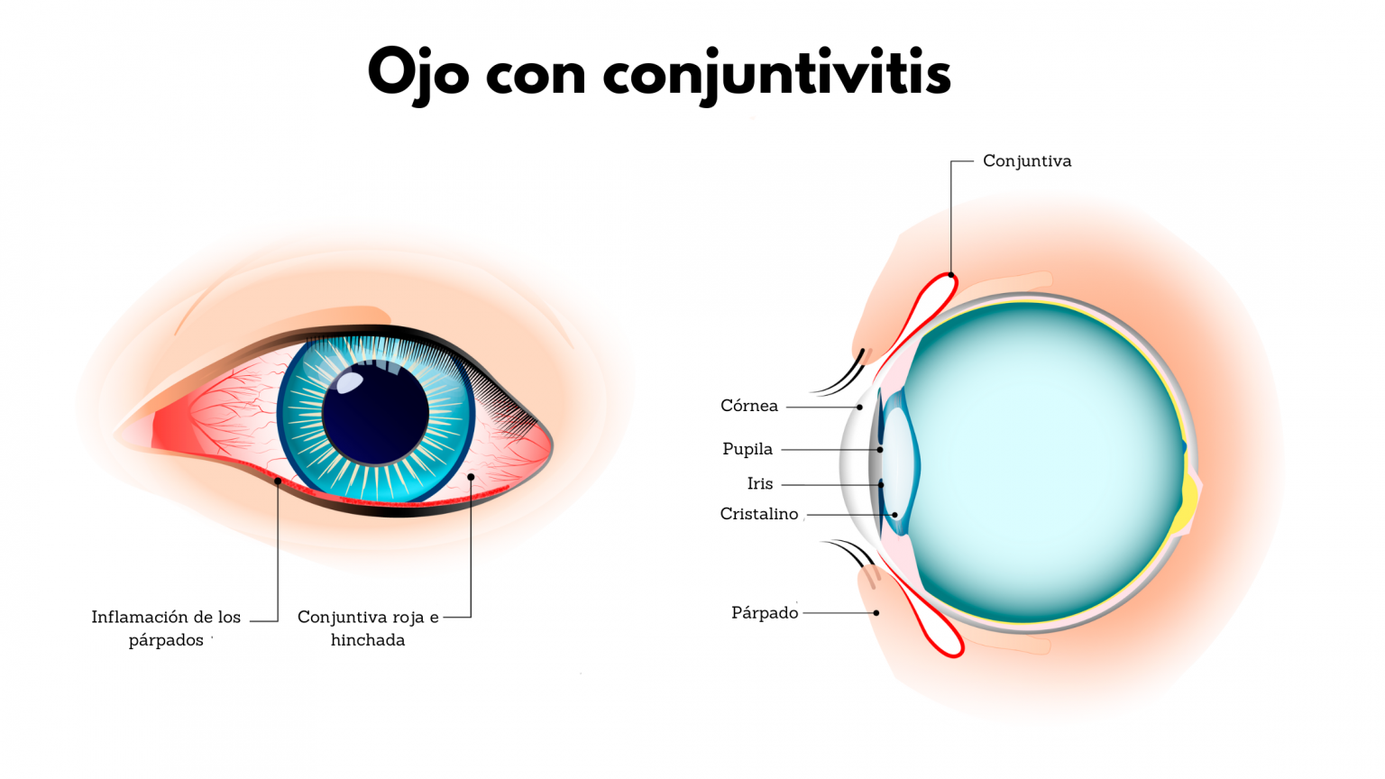 Conjuntivitis: tipos y tratamientos - Óptima Visión