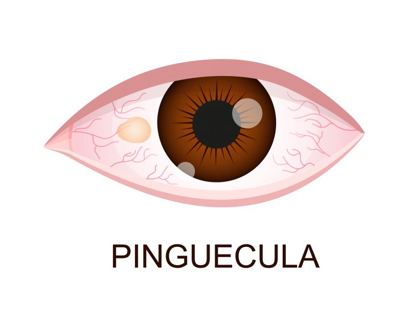 ¿Qué es la pinguécula? - Óptima Visión